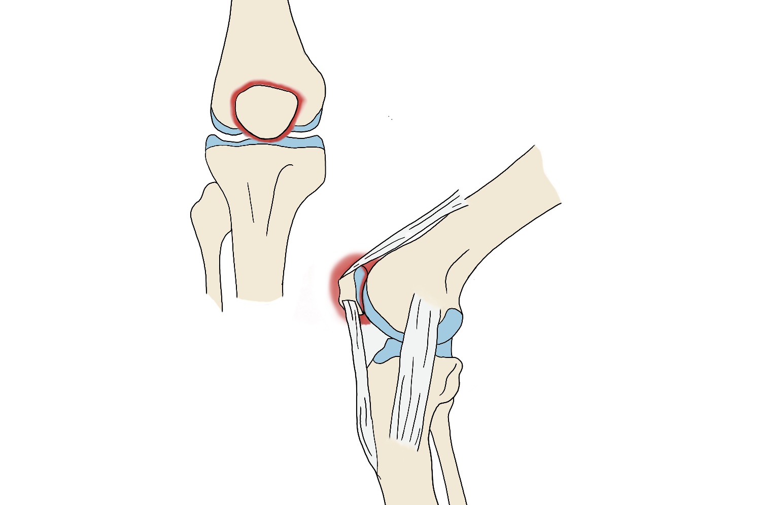 Patella-Schmerzsyndrom – Physiotherapie & Osteopathie Beger | Leipzig Böhlitz-Ehrenberg